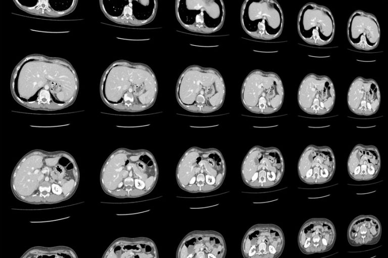Coronary CTA (Coronary CT Angiography) - Lifescan Imaging